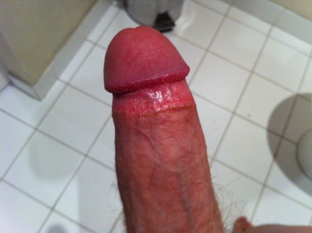 Day 175 Circumcised Adultcircumcision