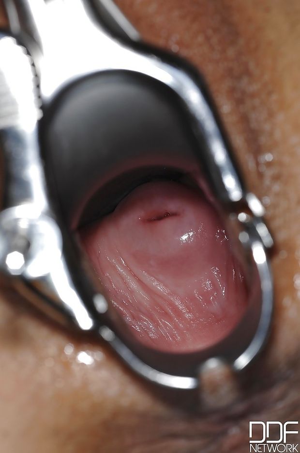 Nice Cervix View Kecra
