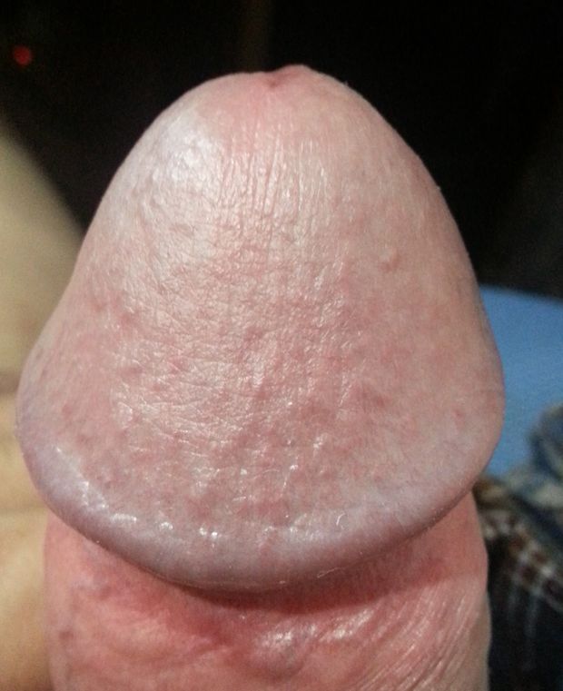 Gland Missleo
