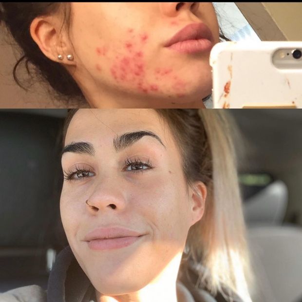 Acne Lololon