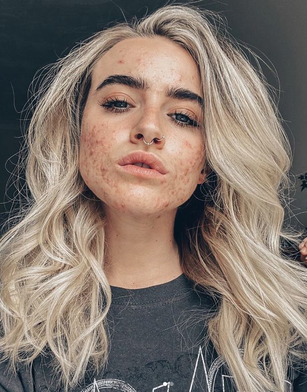 Acne Lololon