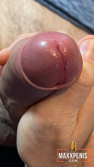 Peeling Foreskin Pics